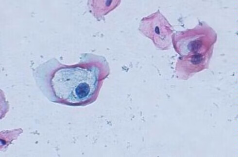 挖空细胞是高危还是低危hpv-京东健康