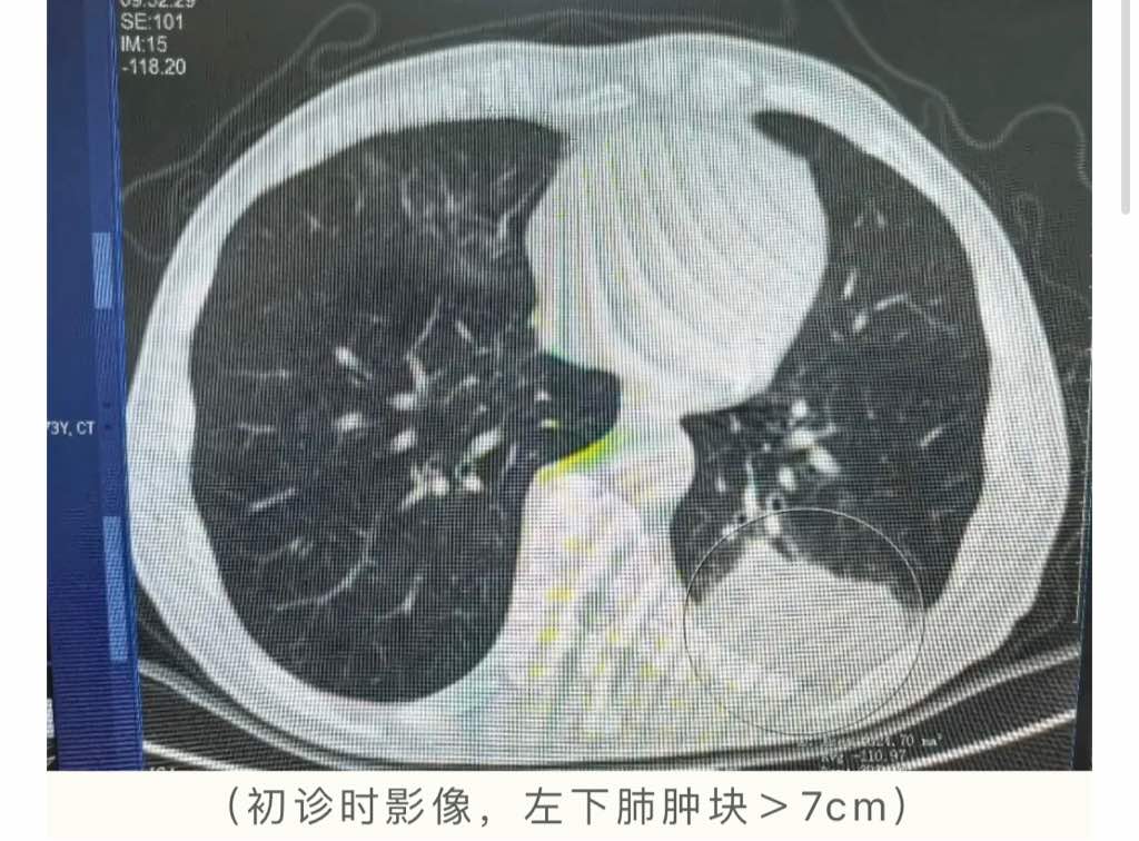 新辅助治疗后手术切除——中晚期肺癌患者的机遇-京东健康