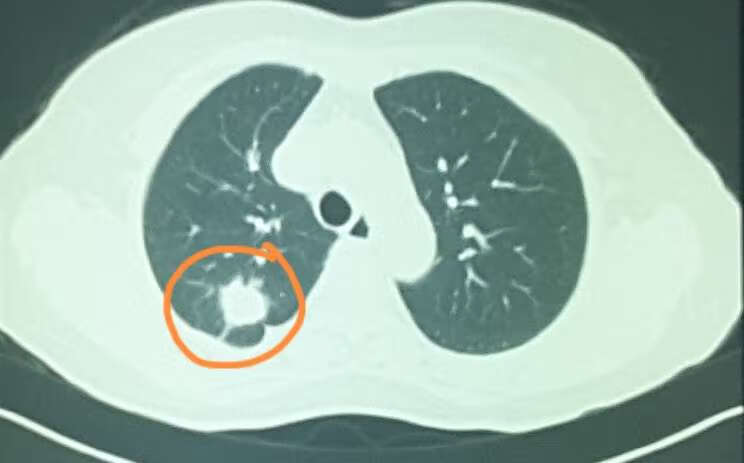 刘懿博士说肺癌（五七五八）查体发现实性肺结节是癌，手术效果也不错-京东健康