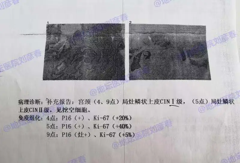 【病例分享】no1 26岁女孩，hpv35型感染，宫颈发生高级别病变女性健康妇产科妇科症状人乳头瘤病毒hpv感染hpv感染
